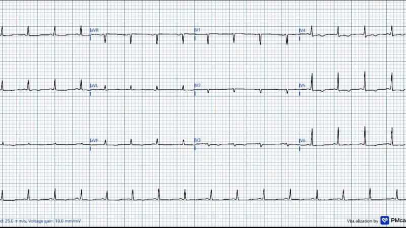 Acute Cardiogenic Shock in a patient with ventricular paced rhythm ...