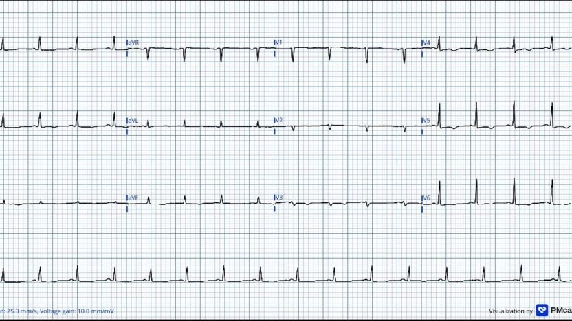 Acute Cardiogenic Shock in a patient with ventricular paced rhythm ...