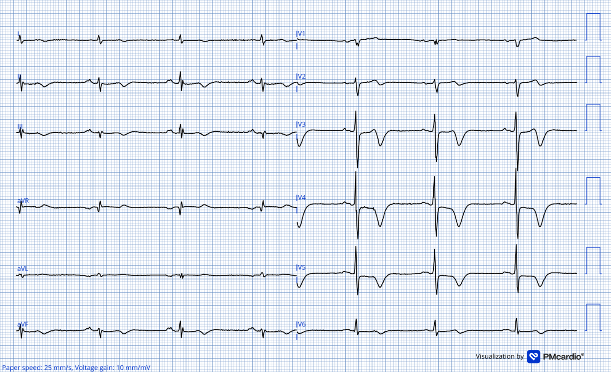 An 80-year-old with intermittent CP - Dr. Smith’s ECG Blog