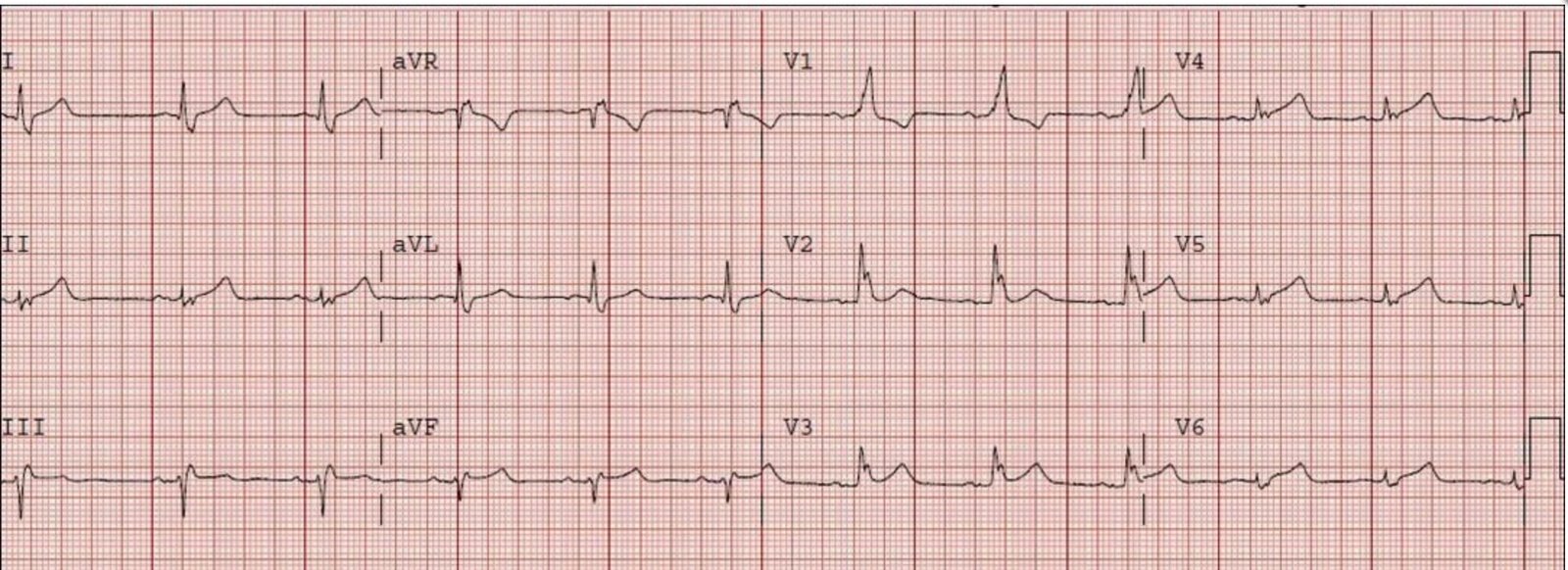 Chest pain and Right Bundle Branch Block - Dr. Smith’s ECG Blog