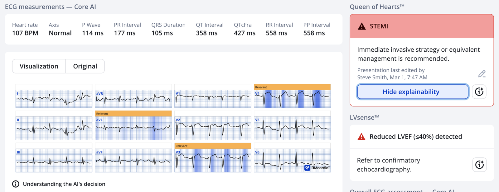 "Sepsis" with an ECG and Echo surprise - Dr. Smith’s ECG Blog