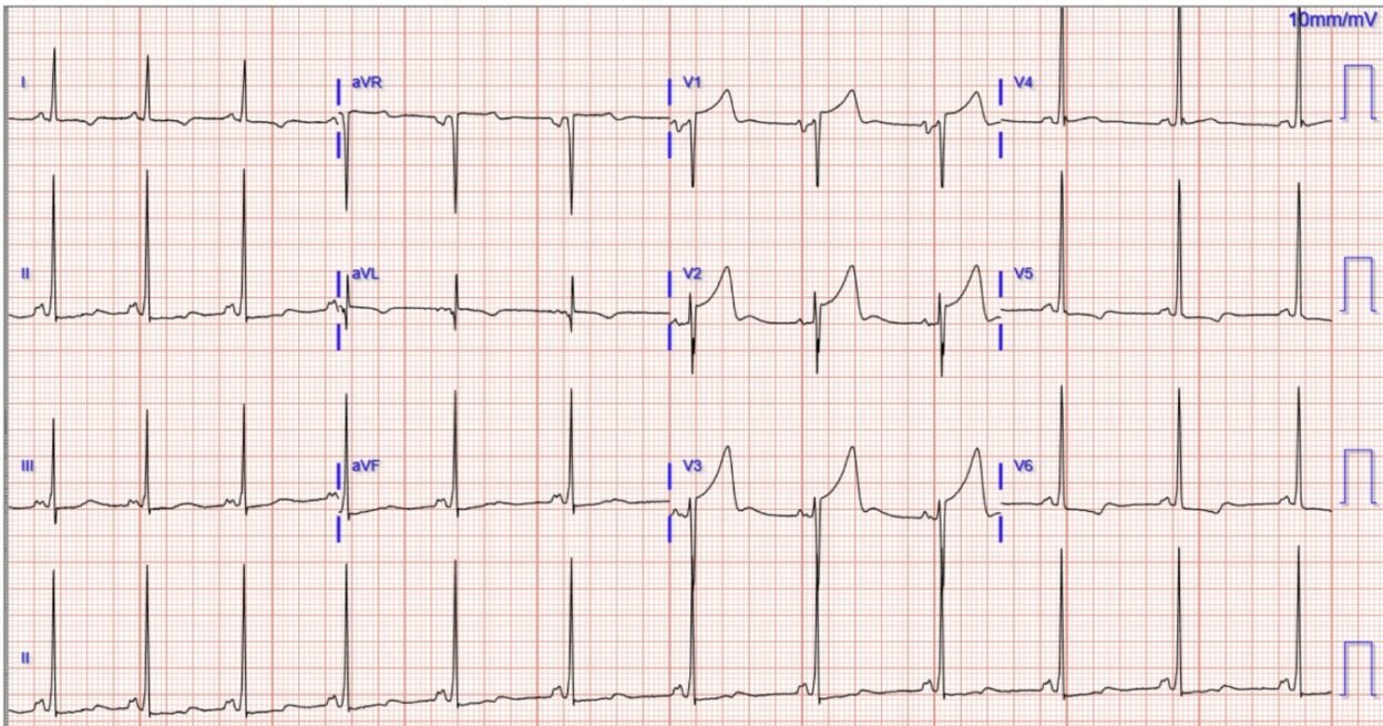 Quiz post: both patients with acute chest pain in the middle of the ...