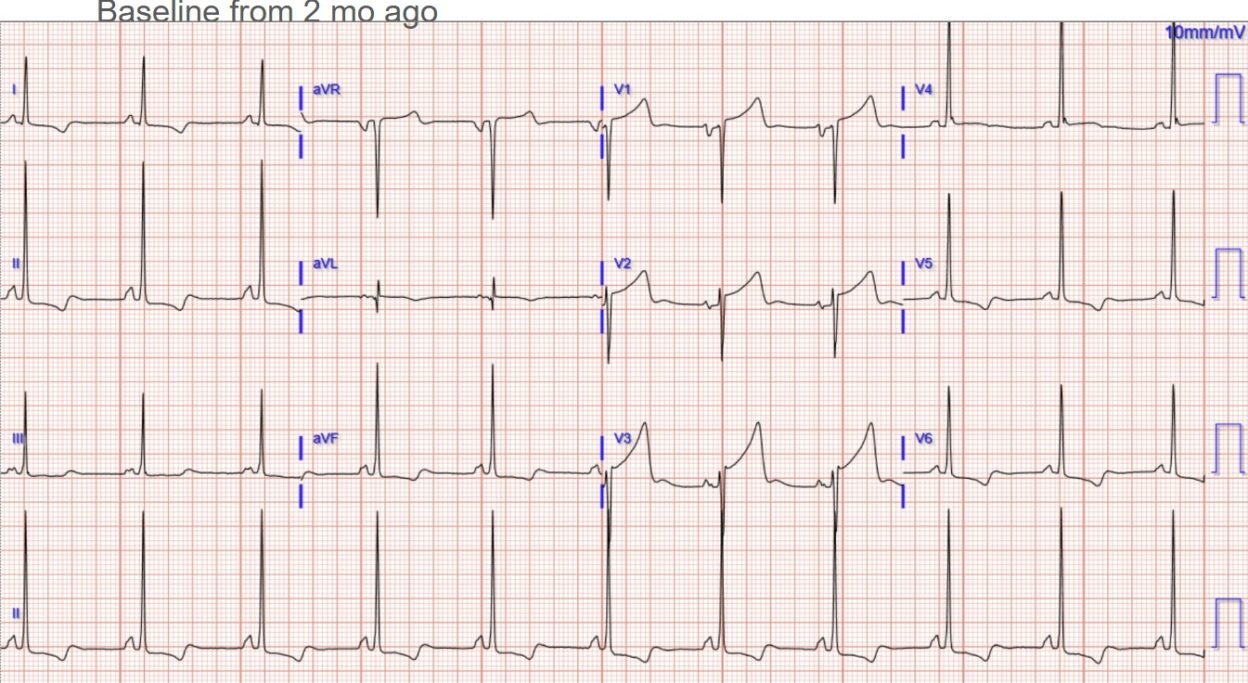 Quiz post: both patients with acute chest pain in the middle of the ...