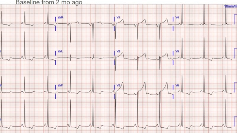 Acute Cardiogenic Shock in a patient with ventricular paced rhythm ...