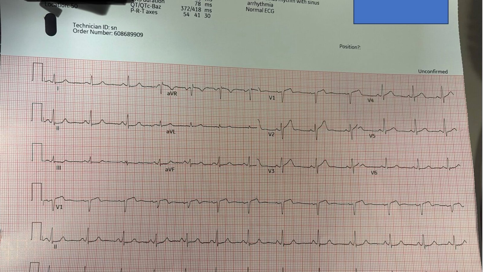 What do you make of these T wave inversions? - Dr. Smith’s ECG Blog