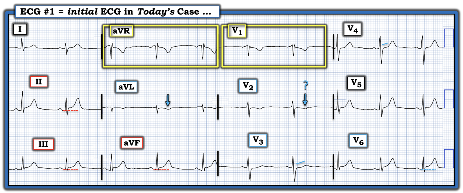 Signed off as "normal, no concern" - Dr. Smith’s ECG Blog