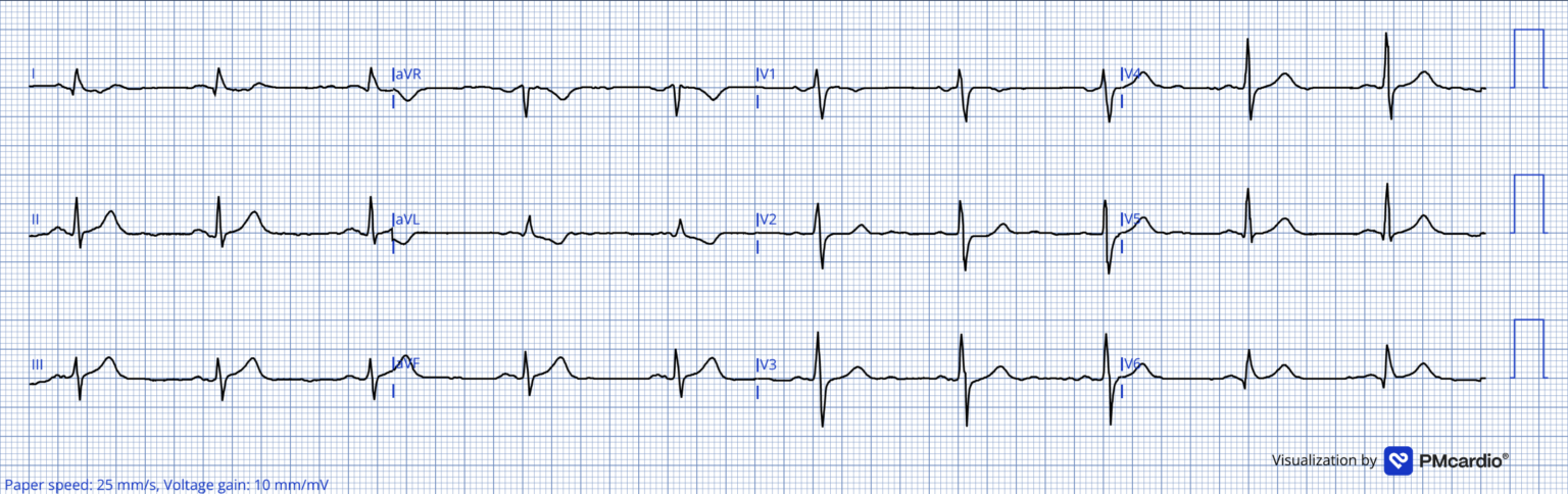 Reciprocally Inverted Hyperacute T-Wave. What is that? - Dr. Smith’s ...