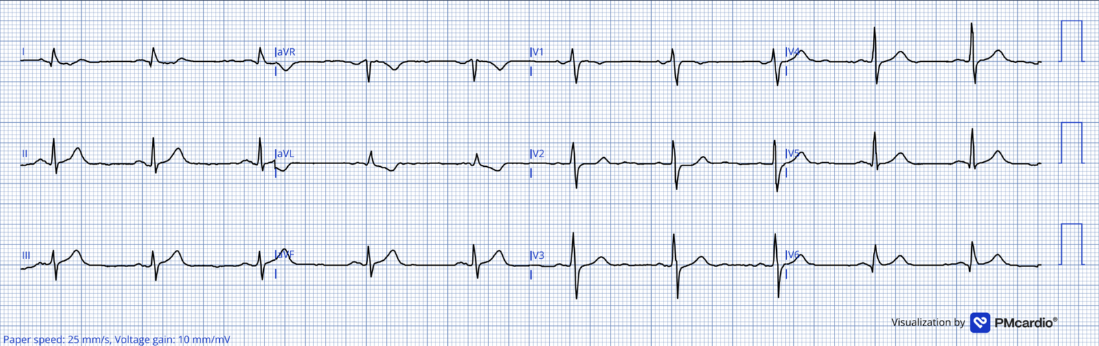 Reciprocally Inverted Hyperacute T-Wave. What is that? - Dr. Smith’s ...