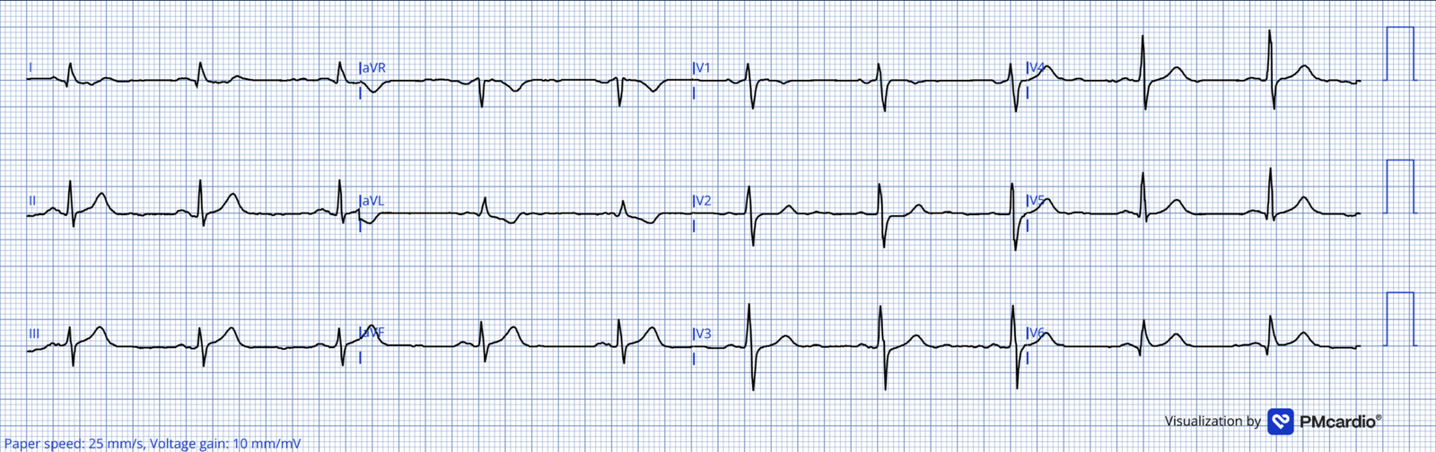 Reciprocally Inverted Hyperacute T-Wave. What is that? - Dr. Smith’s ...