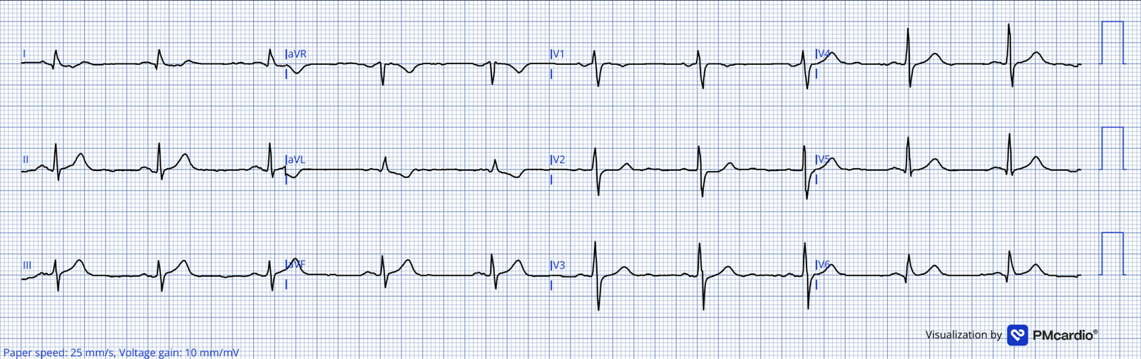 Reciprocally Inverted Hyperacute T-Wave. What is that? - Dr. Smith’s ...
