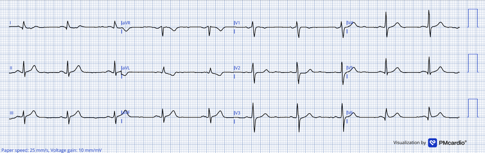 Reciprocally Inverted Hyperacute T-Wave. What is that? - Dr. Smith’s ...
