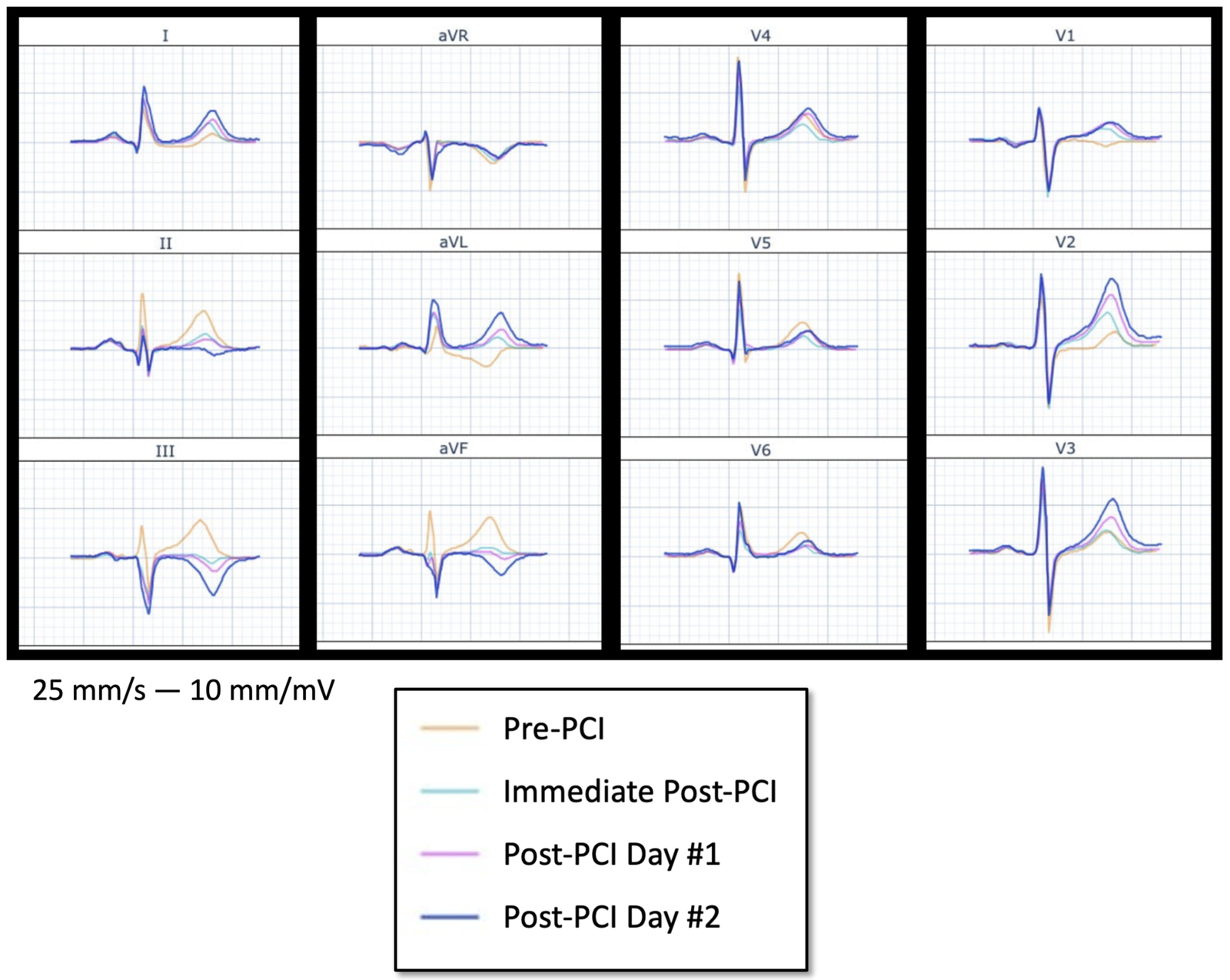 Reciprocally Inverted Hyperacute T-Wave. What is that? - Dr. Smith’s ...