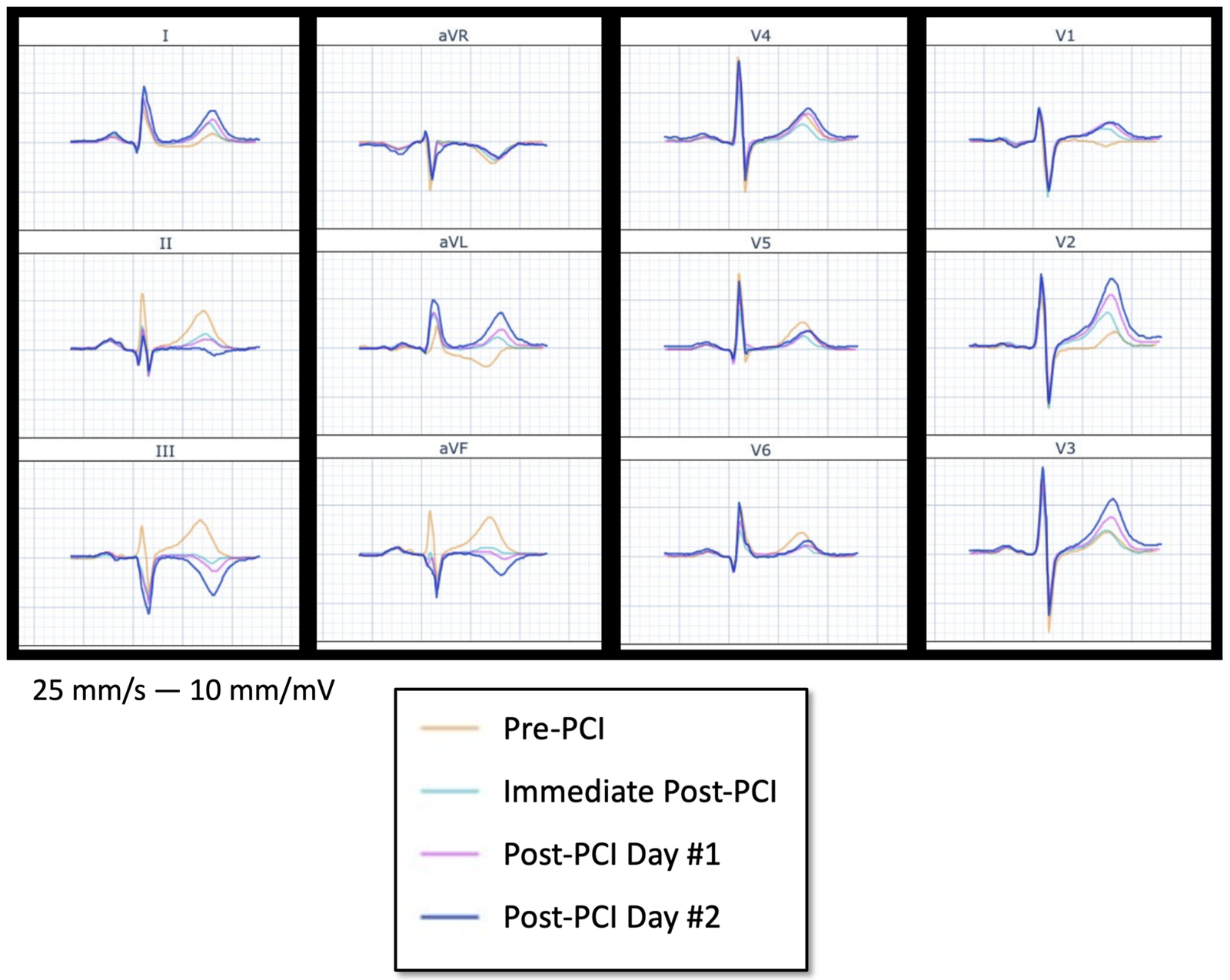 Reciprocally Inverted Hyperacute T-Wave. What is that? - Dr. Smith’s ...