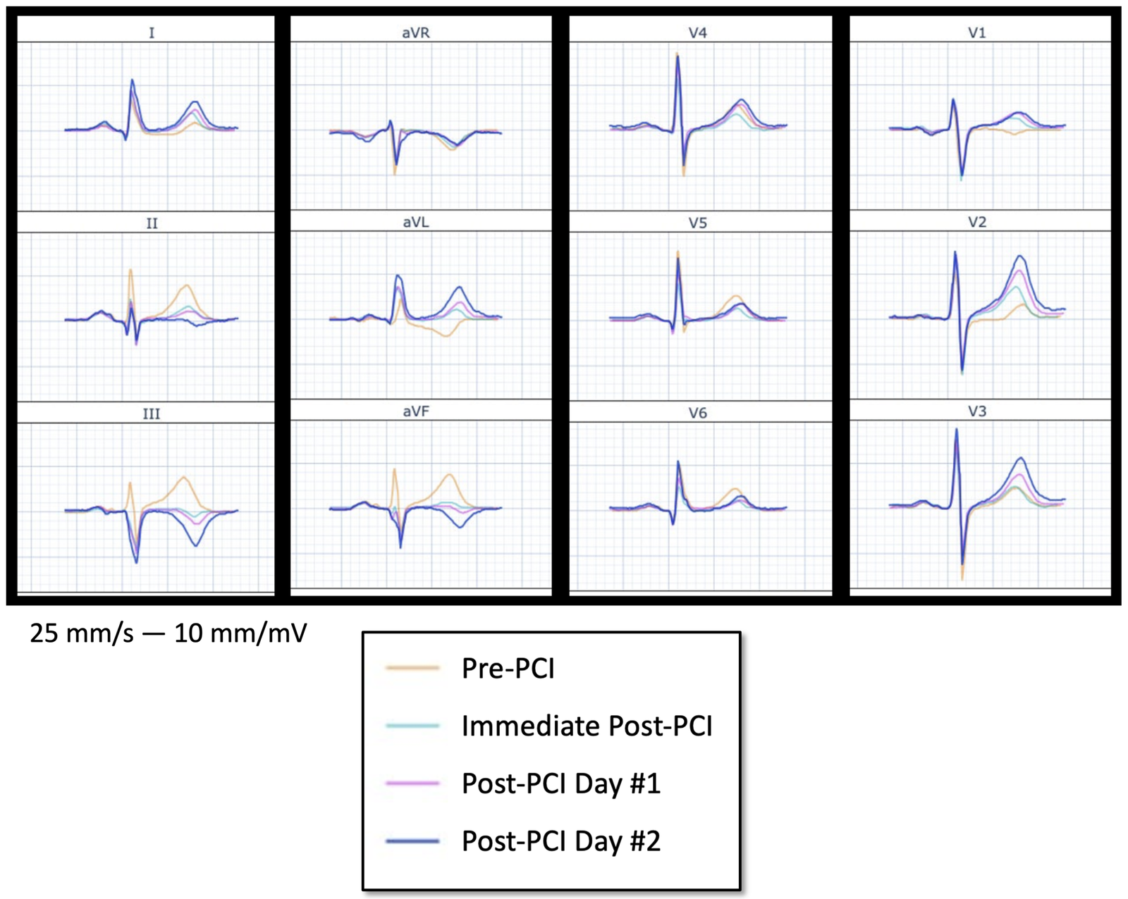 Reciprocally Inverted Hyperacute T-Wave. What is that? - Dr. Smith’s ...