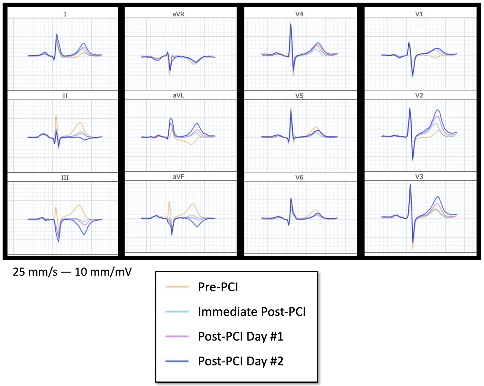 Reciprocally Inverted Hyperacute T-Wave. What is that? - Dr. Smith’s ...