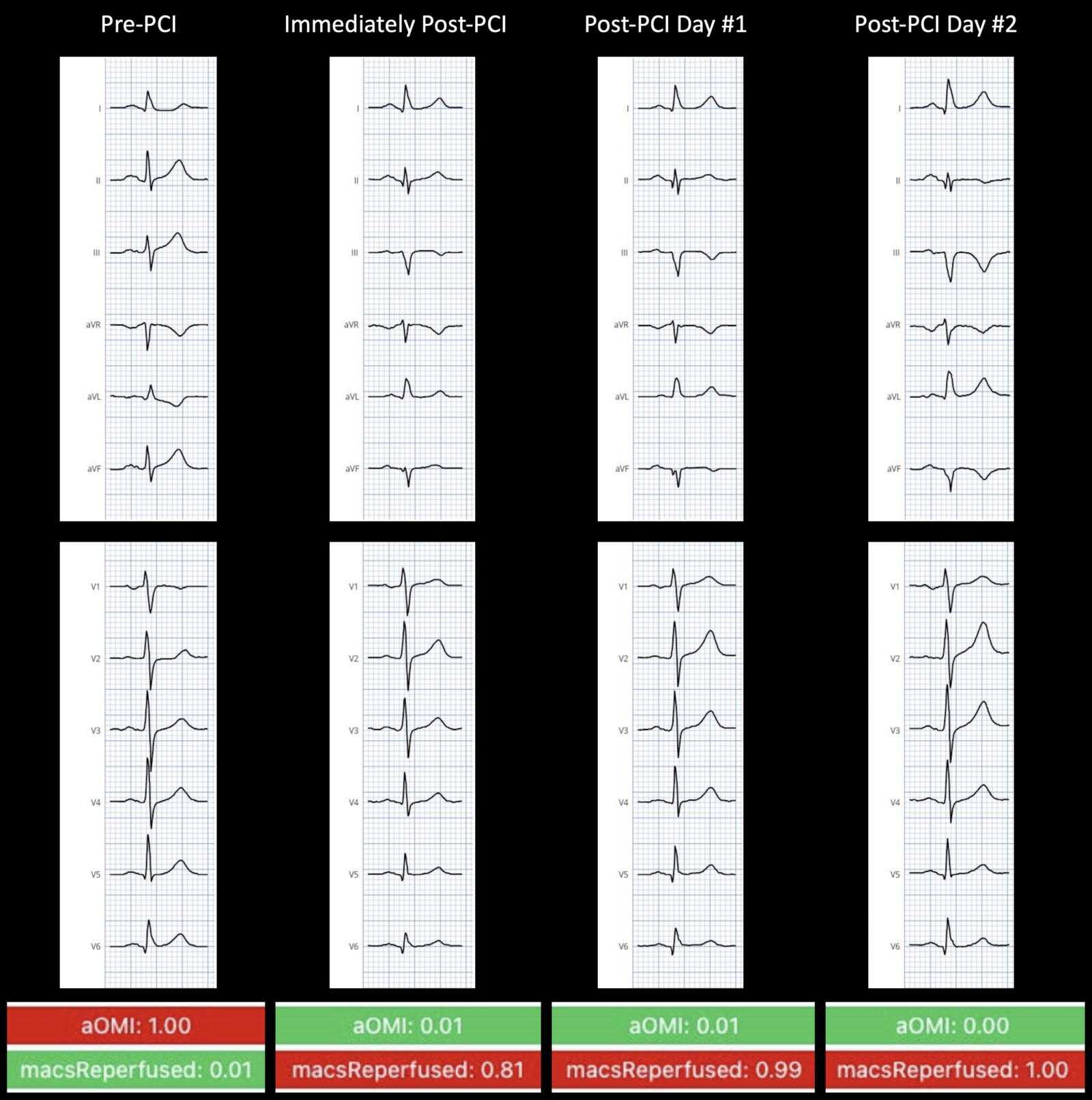 Reciprocally Inverted Hyperacute T-Wave. What is that? - Dr. Smith’s ...