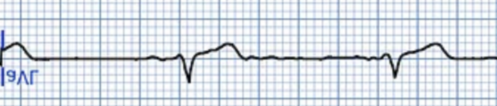 Reciprocally Inverted Hyperacute T-Wave. What is that? - Dr. Smith’s ...