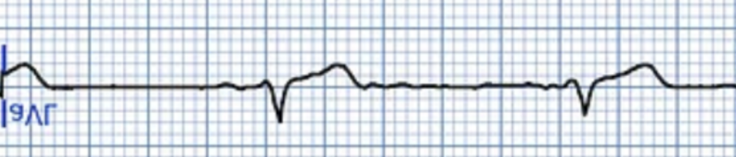 Reciprocally Inverted Hyperacute T-Wave. What is that? - Dr. Smith’s ...