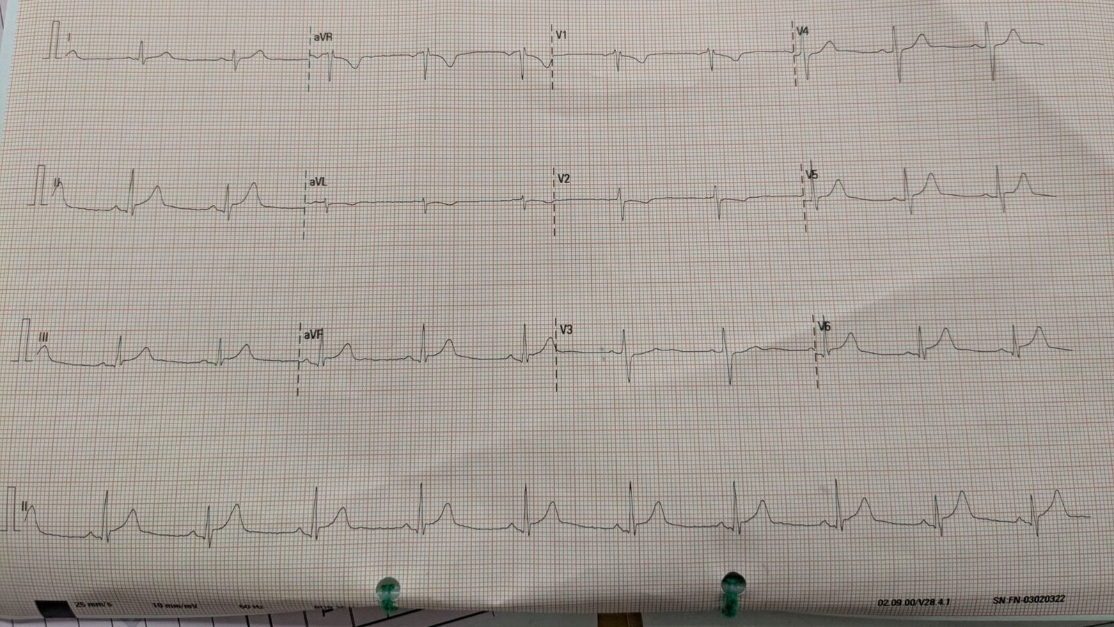 Signed off as "normal, no concern" - Dr. Smith’s ECG Blog