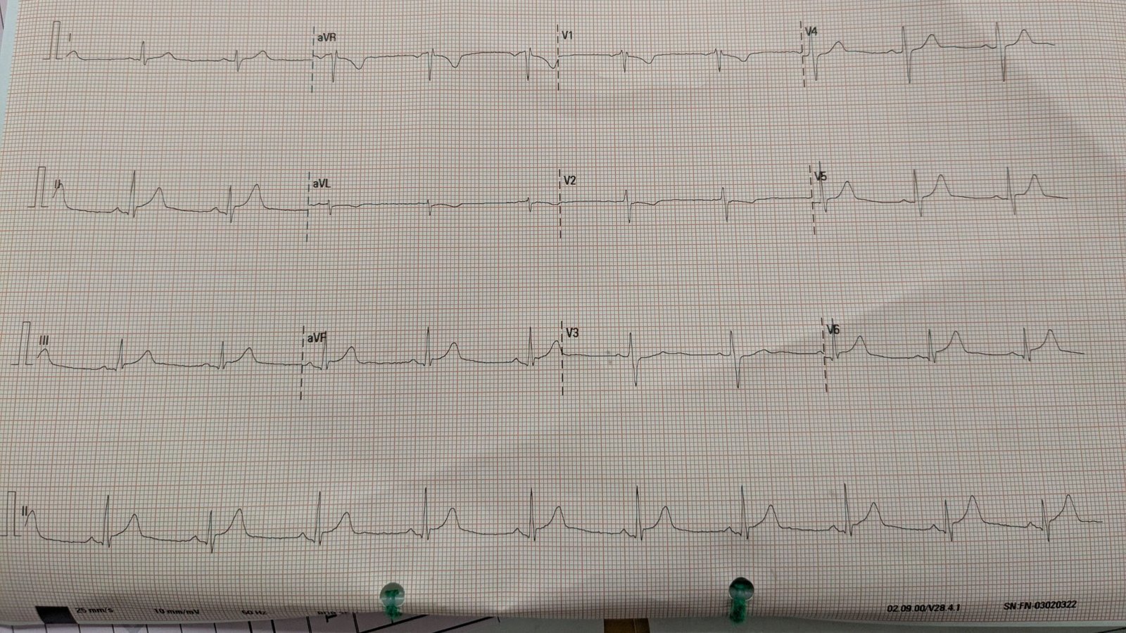 Signed off as "normal, no concern" - Dr. Smith’s ECG Blog