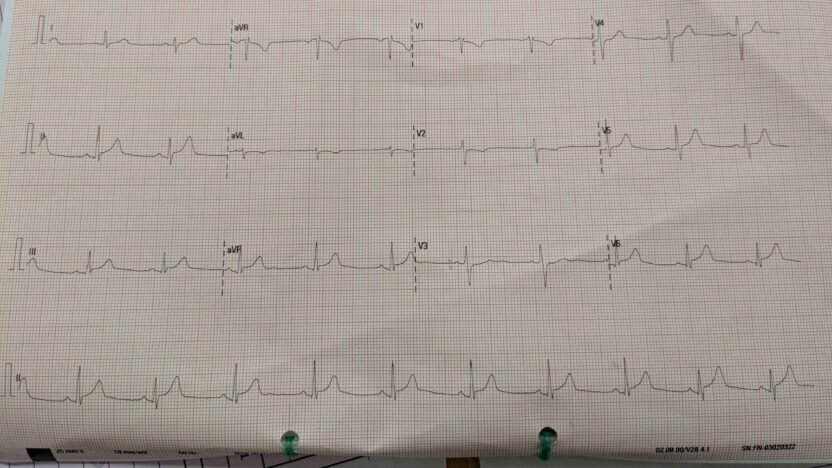 Reciprocally Inverted Hyperacute T-Wave. What is that? - Dr. Smith’s ...