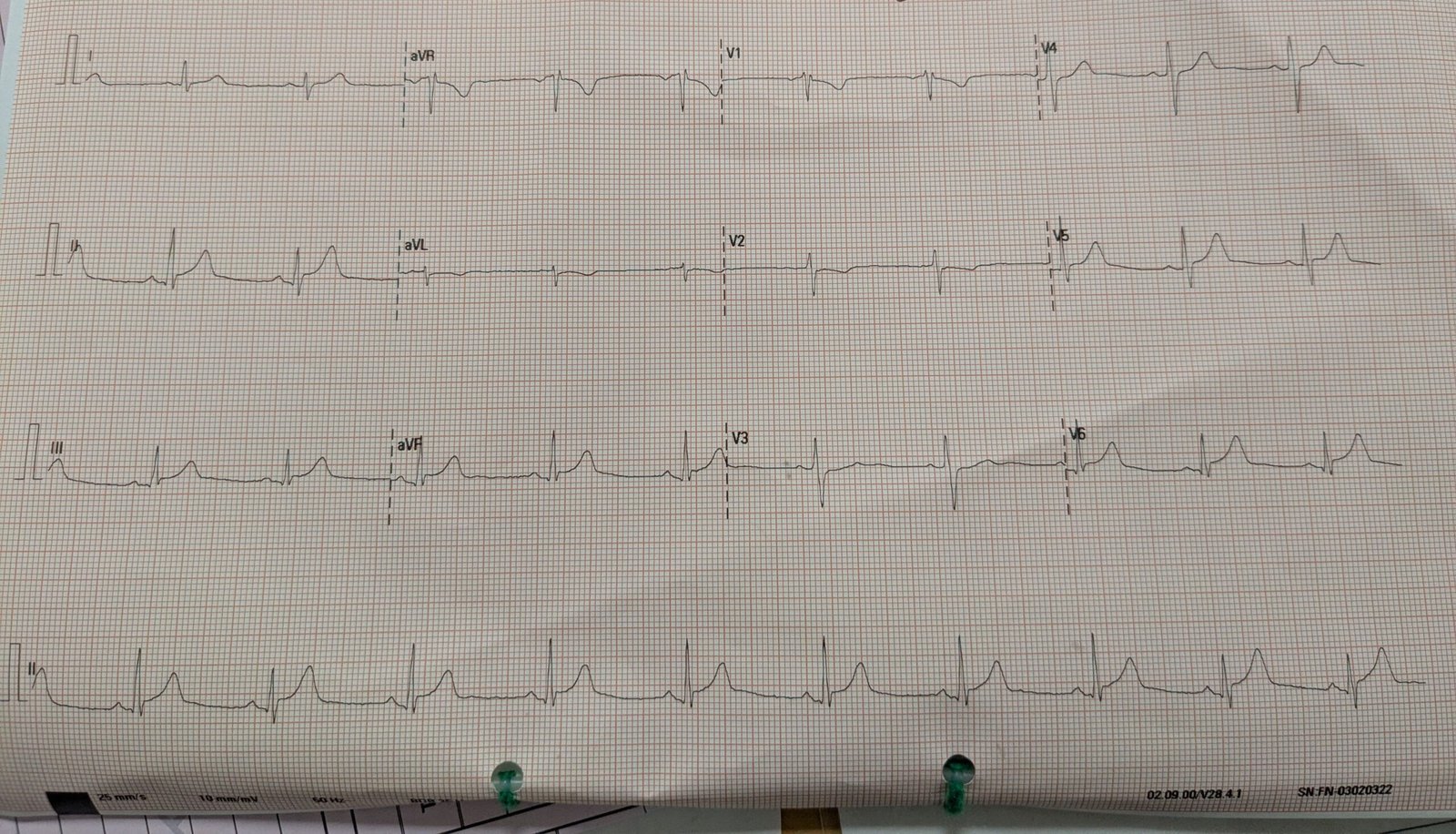 Signed off as "normal, no concern" - Dr. Smith’s ECG Blog