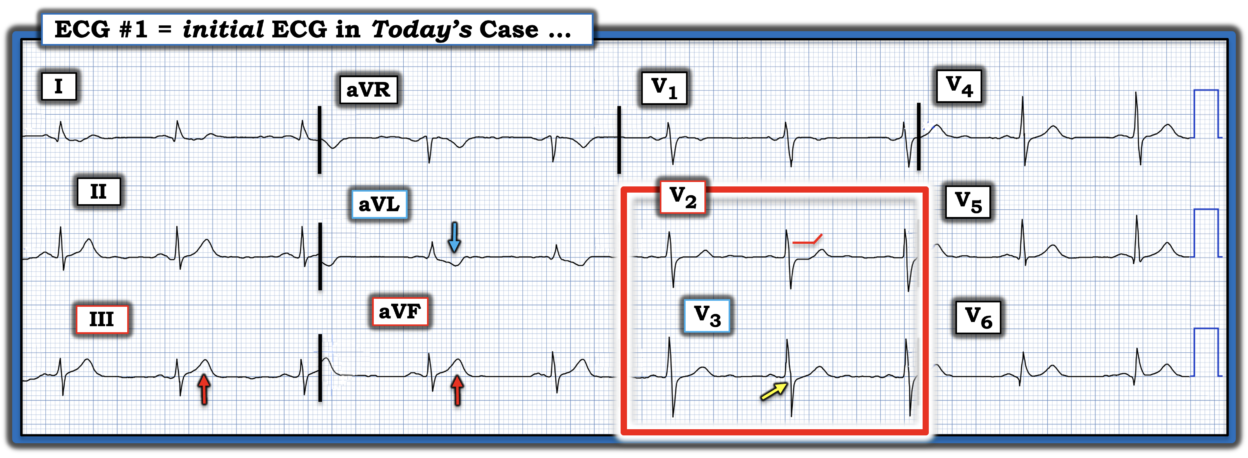 Reciprocally Inverted Hyperacute T-Wave. What is that? - Dr. Smith’s ...