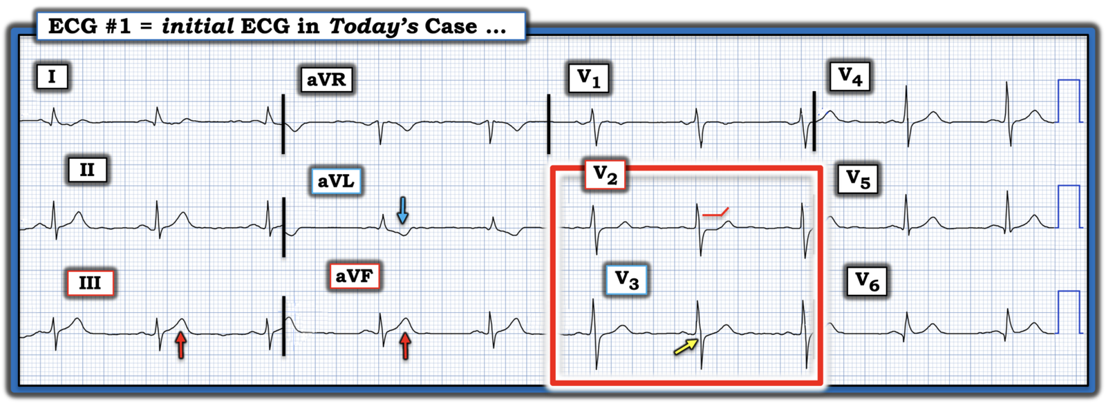 Reciprocally Inverted Hyperacute T-Wave. What is that? - Dr. Smith’s ...
