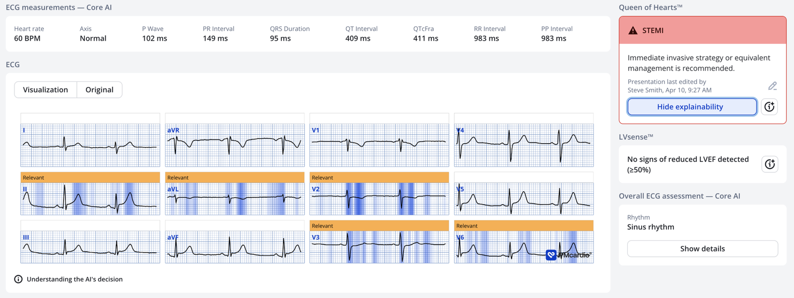 Signed off as "normal, no concern" - Dr. Smith’s ECG Blog