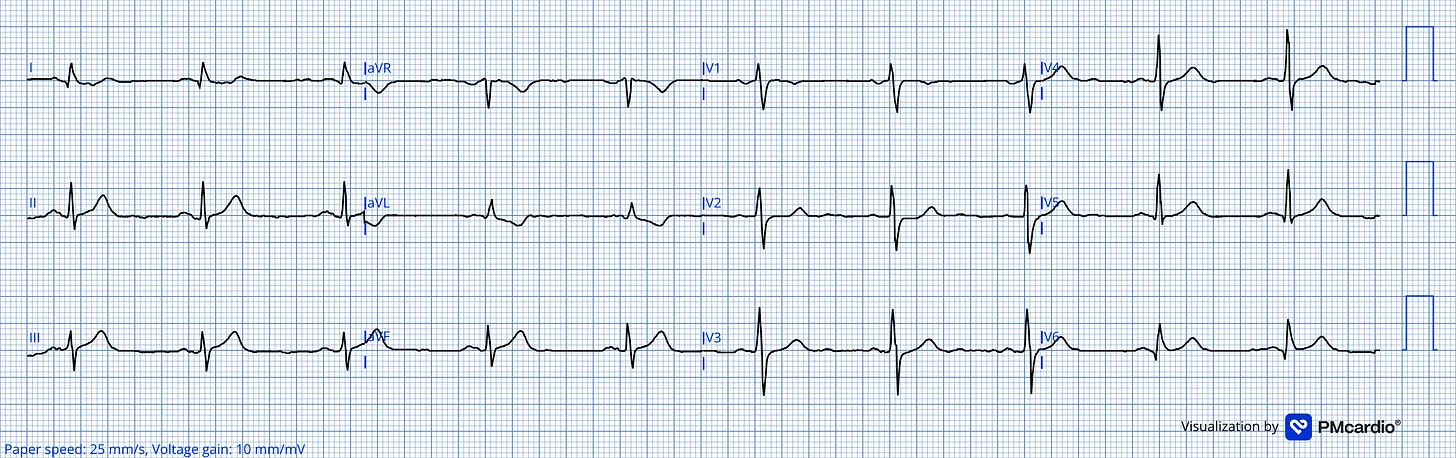 Reciprocally Inverted Hyperacute T-Wave. What is that? - Dr. Smith’s ...