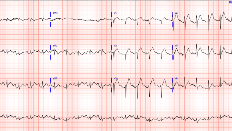 What do you make of these T wave inversions? - Dr. Smith’s ECG Blog