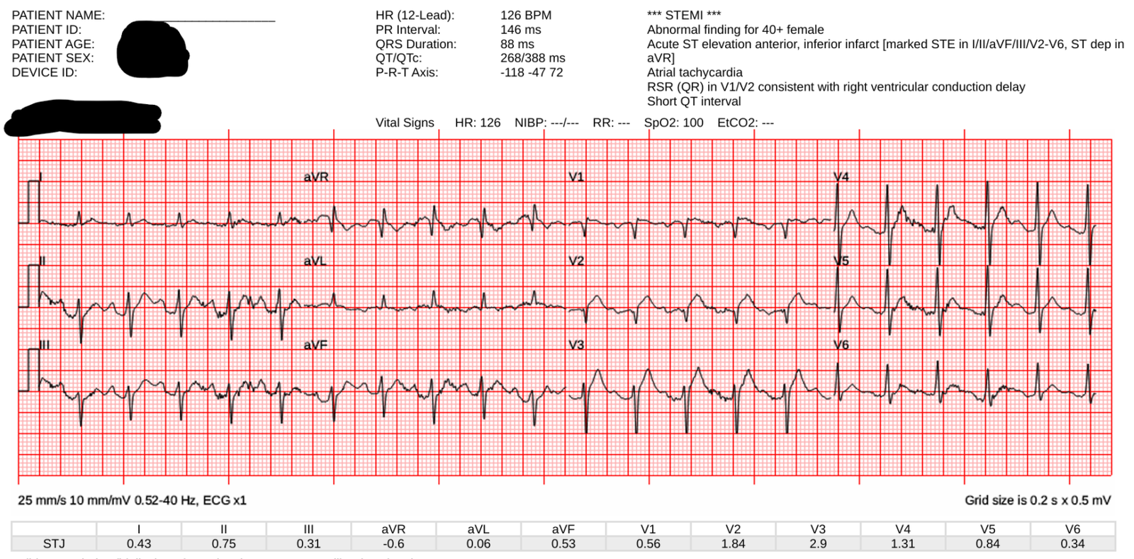 Acute altered mental status, ST Elevation, Hyperacute T-waves, and ...