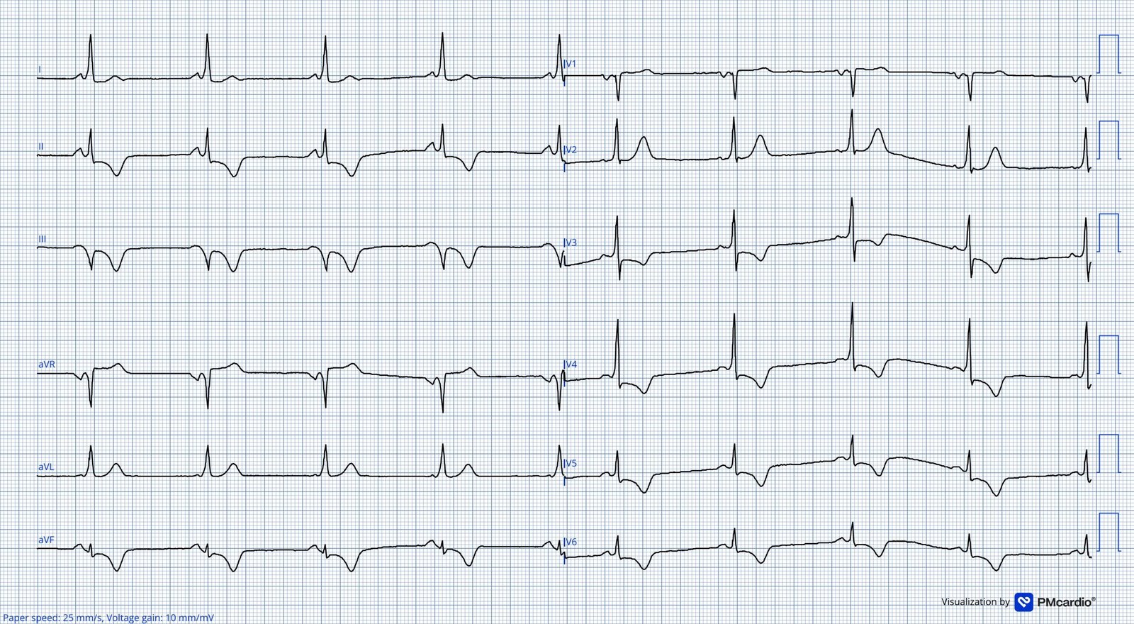 Can you figure out this unusual Wide Complex Tachycardia? - Dr. Smith’s ...