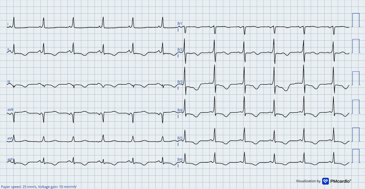 Can you figure out this unusual Wide Complex Tachycardia? - Dr. Smith’s ...