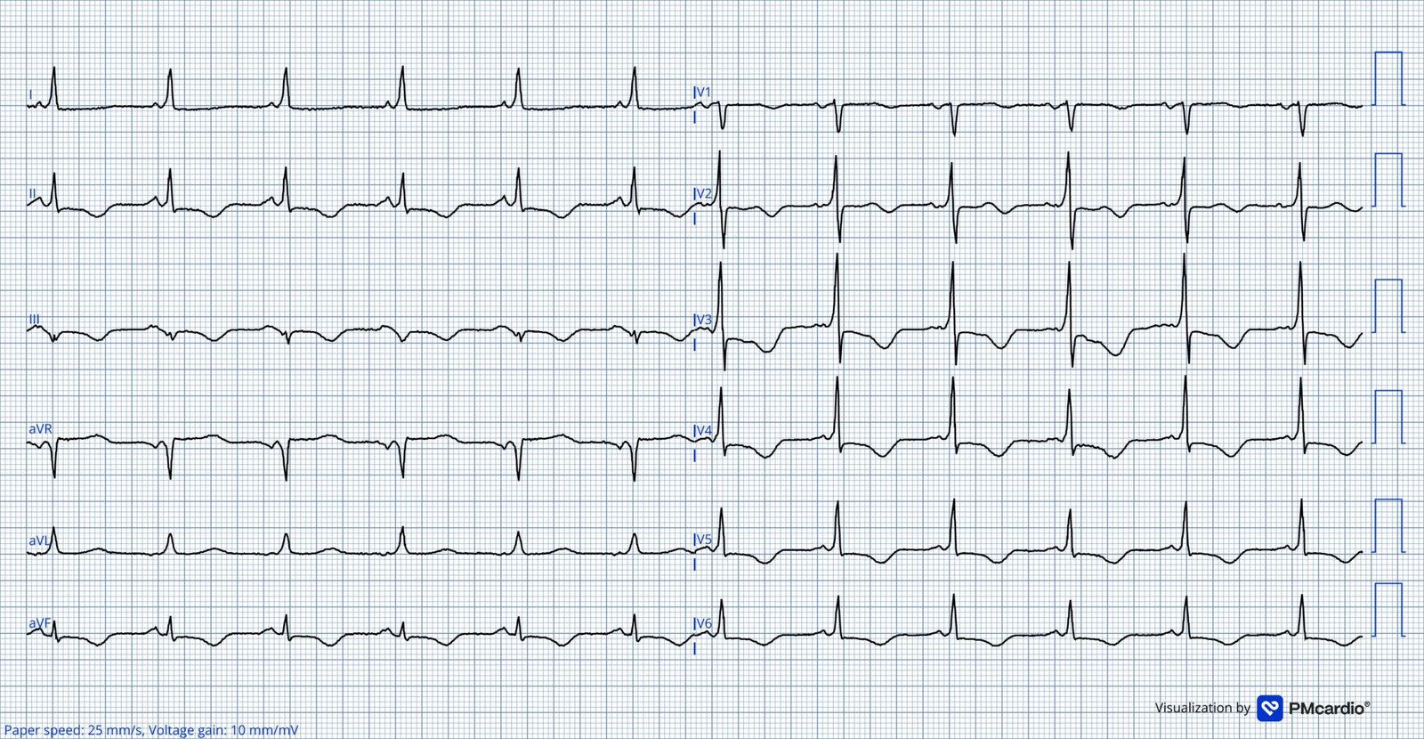 Can you figure out this unusual Wide Complex Tachycardia? - Dr. Smith’s ...