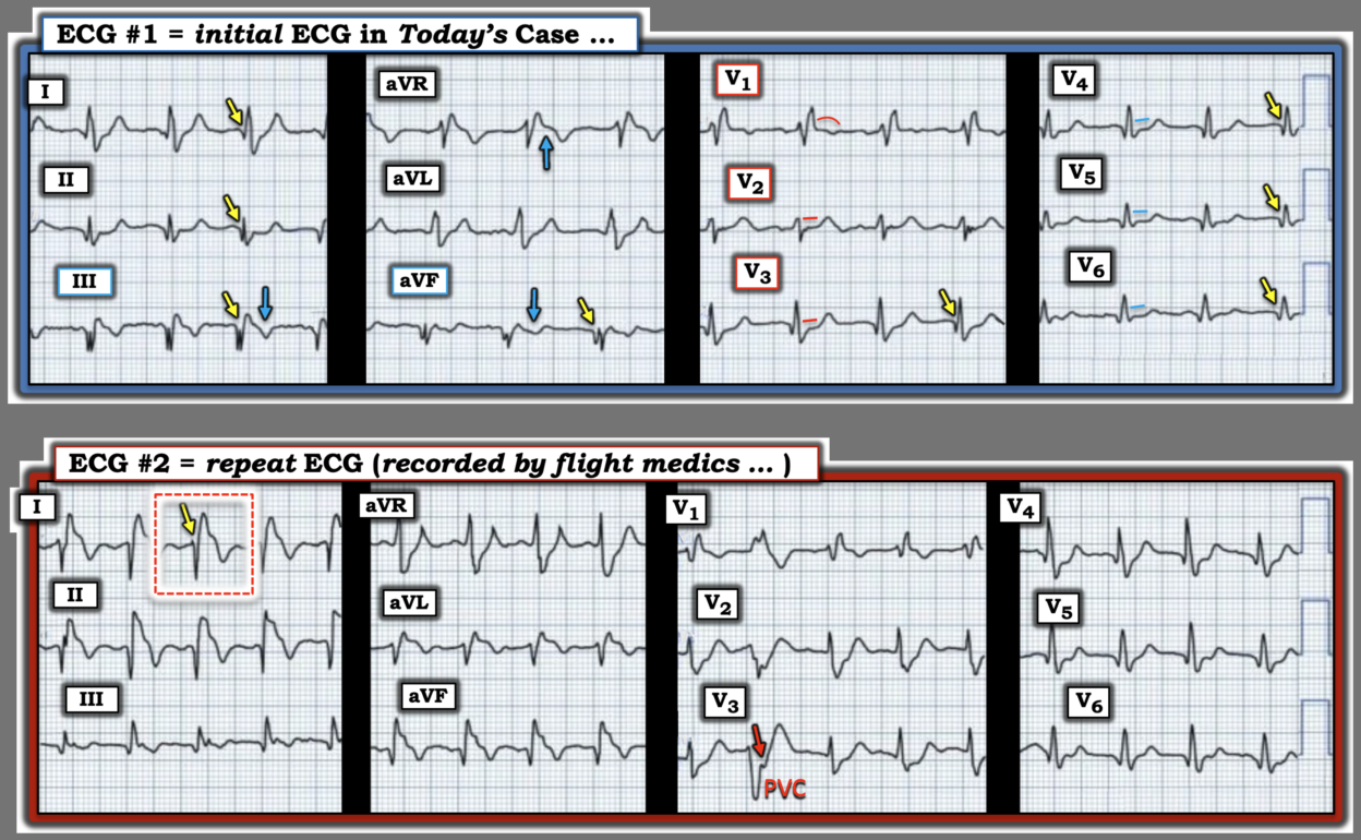 The Right Decision for the Wrong Reason? - Dr. Smith’s ECG Blog
