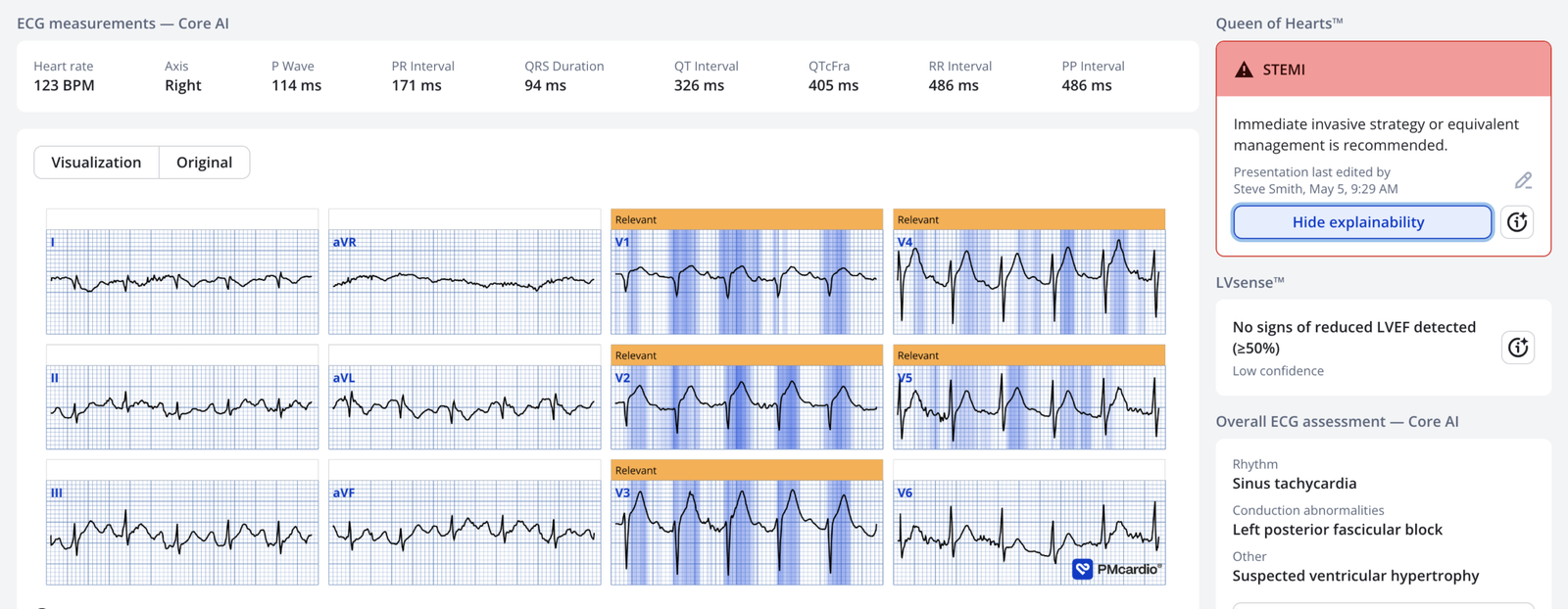 Acute altered mental status, ST Elevation, Hyperacute T-waves, and ...