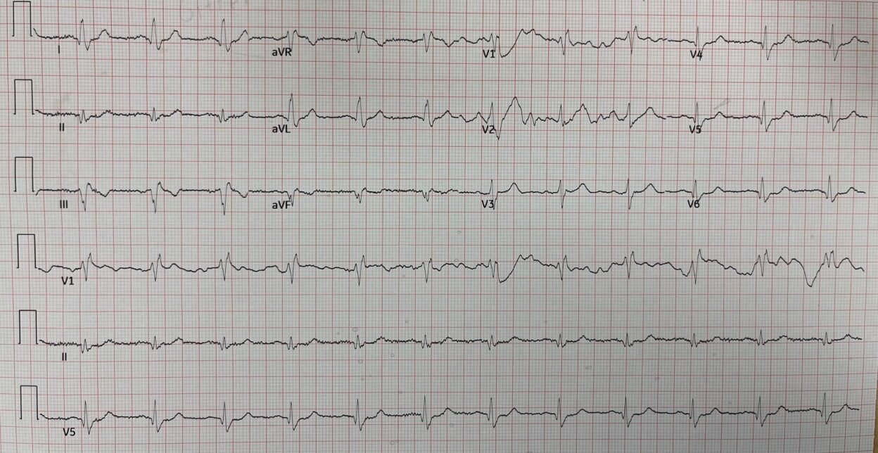 The Right Decision for the Wrong Reason? - Dr. Smith’s ECG Blog