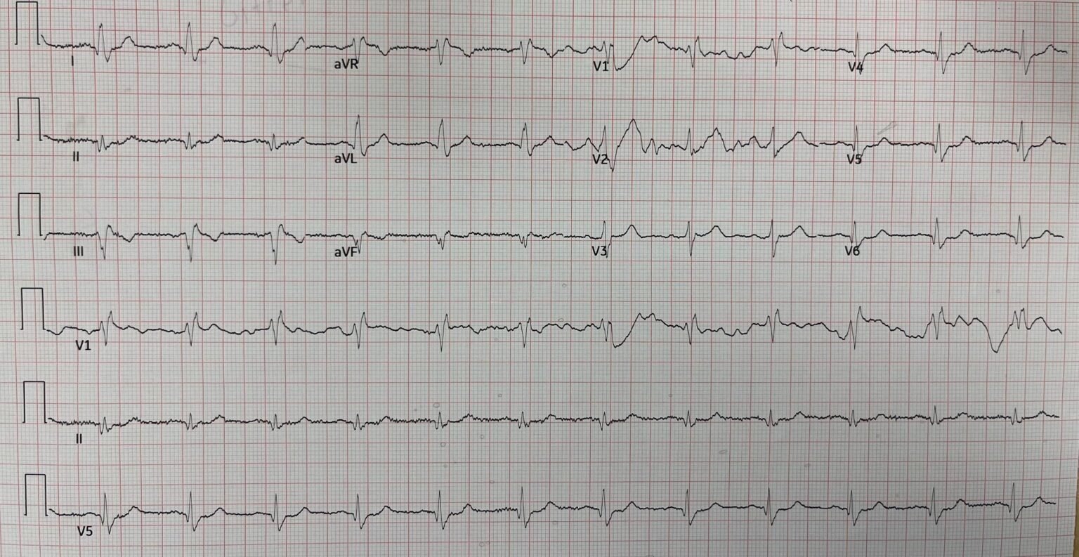 The Right Decision for the Wrong Reason? - Dr. Smith’s ECG Blog