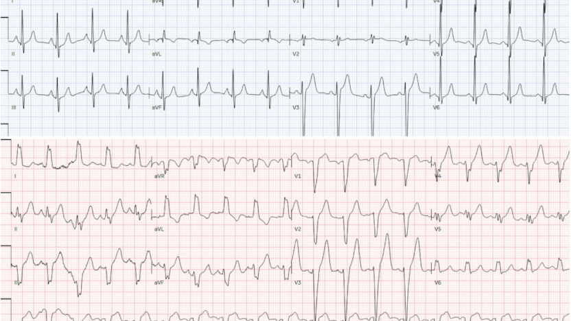 Right Bundle Branch Block (RBBB) with Anterolateral STEMI - Dr. Smith’s ...