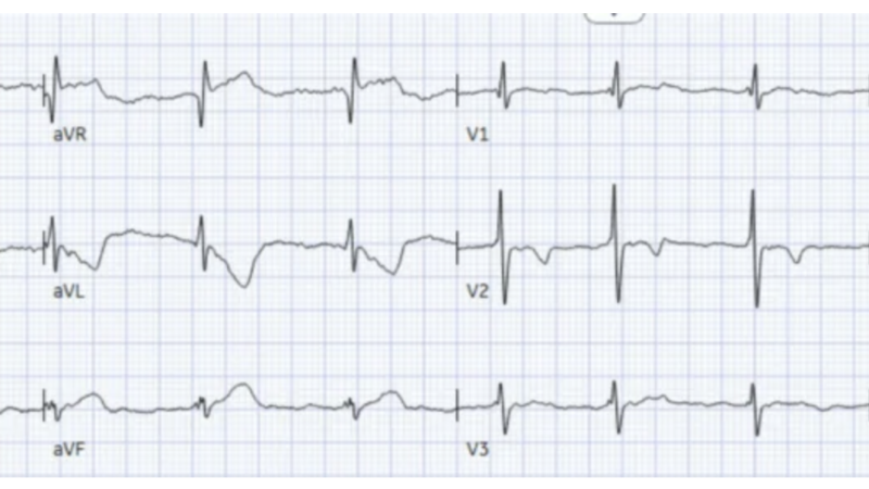 Right Bundle Branch Block (RBBB) with Anterolateral STEMI - Dr. Smith’s ...