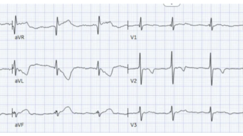 Right Bundle Branch Block (RBBB) with Anterolateral STEMI - Dr. Smith’s ...